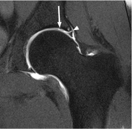 Physical Therapy for Torn Labrum | Cawley Physical Therapy