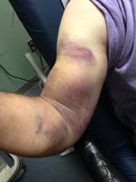 Physical Therapy for Bicep Tear | Cawley Physical Therapy